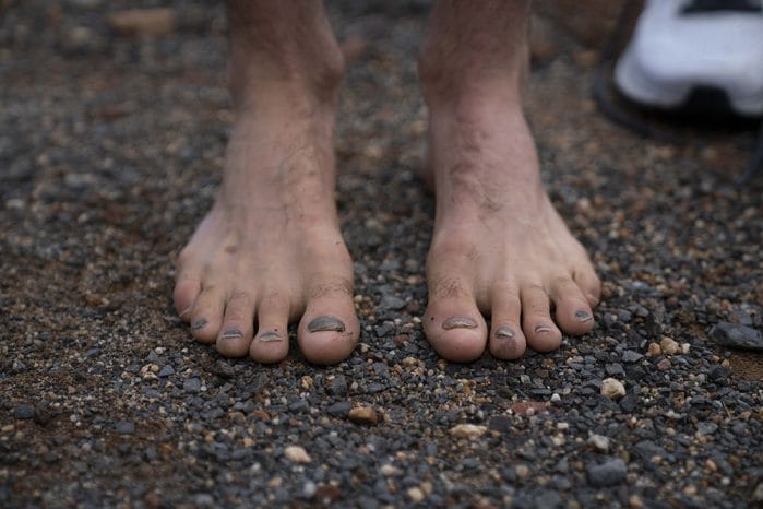 5 Easy Solutions To Your Gross Running Problems! - Runner's World